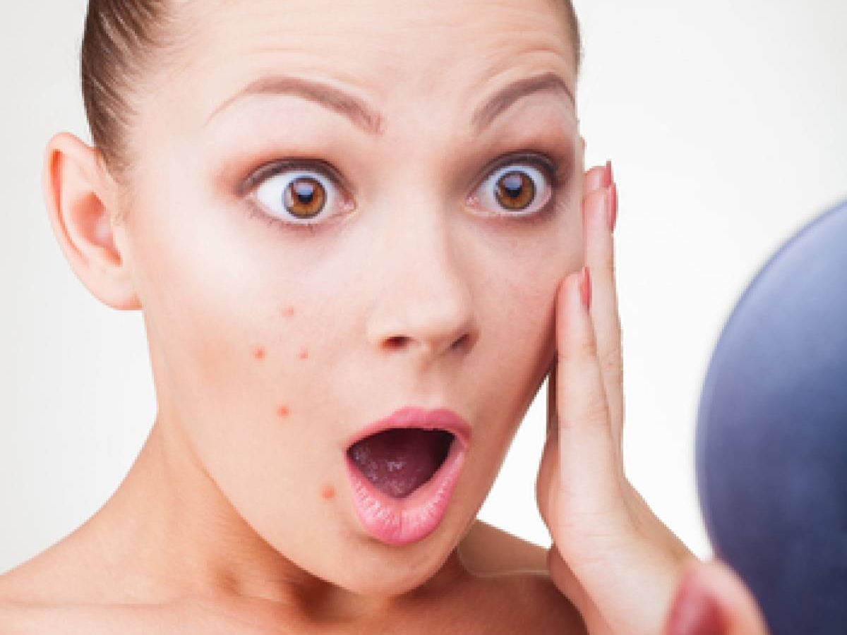 ¿Cómo cuidar la piel propensa al acné y a la dermatitis seborreica ...